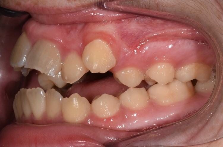 Periodontal disease (gum disease) - Northshore Dental and Oral Health
