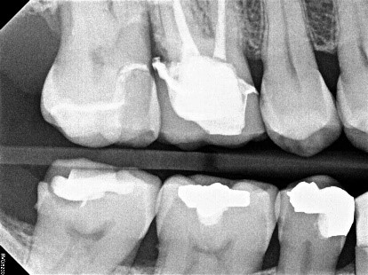Periodontal disease (gum disease) - Northshore Dental and Oral Health