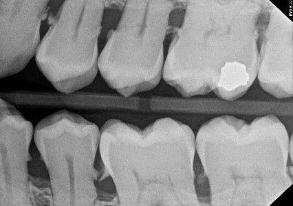 Periodontal disease (gum disease) - Northshore Dental and Oral Health